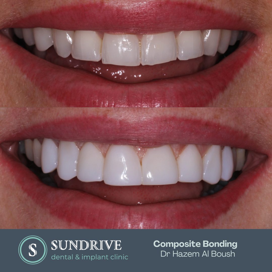 Composite Bonding - Sun Drive Dental and Implant Clinic