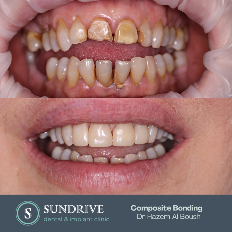 Composite Bonding - Sun Drive Dental and Implant Clinic