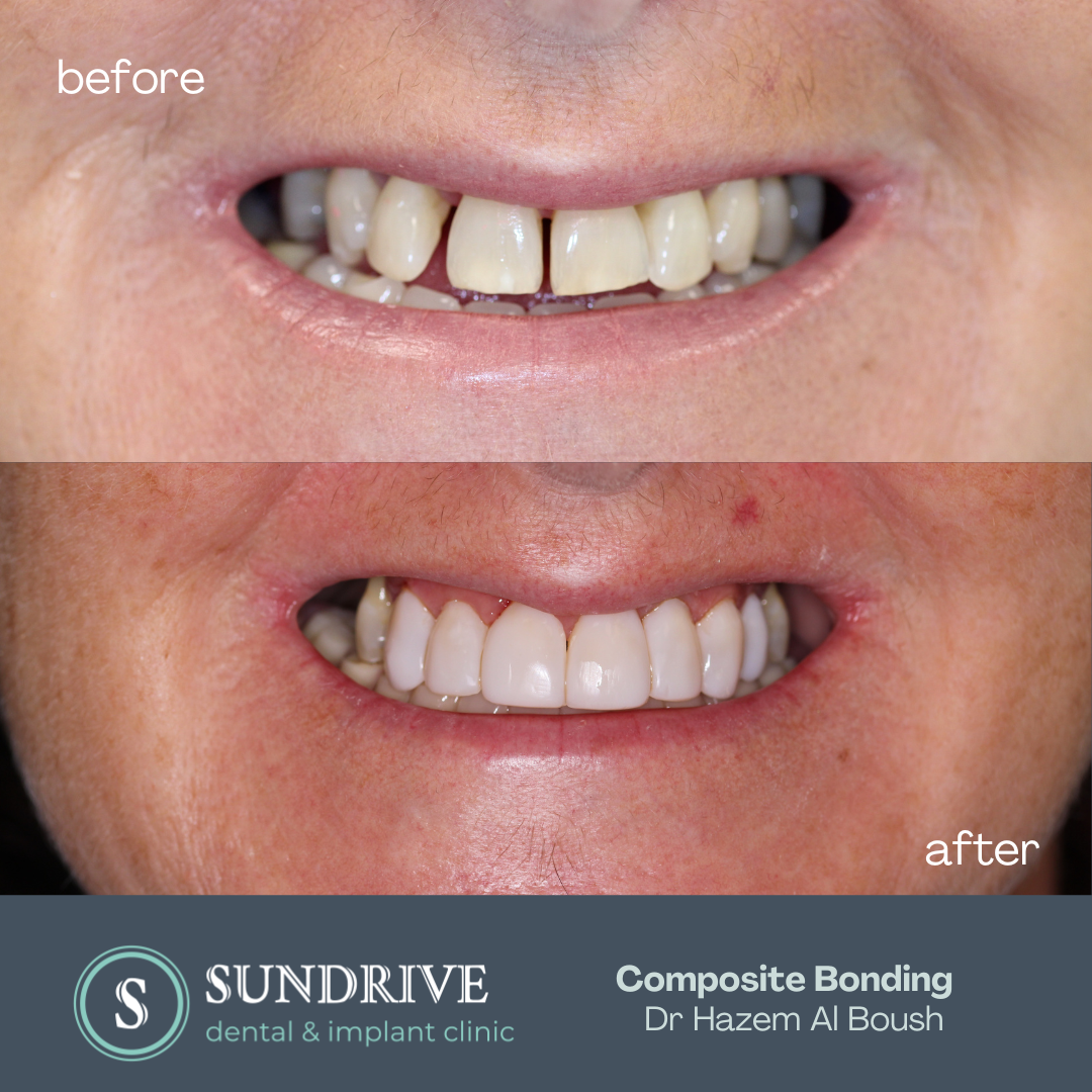 Composite Bonding - Sun Drive Dental and Implant Clinic